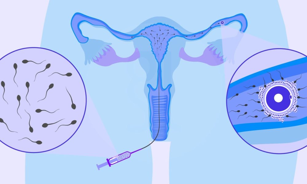 Intrauterine Insemination (IUI) - GynoLife IVF